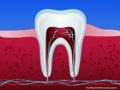 How to Save a Tooth With No Root Canal | Healthy Home Economist