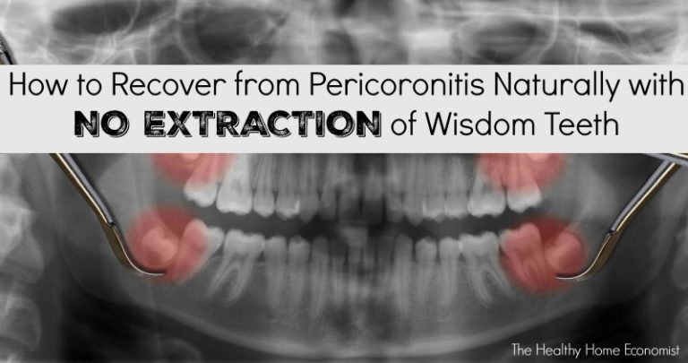 Wisdom Tooth Pericoronitis? How to Avoid Extraction | Healthy Home ...